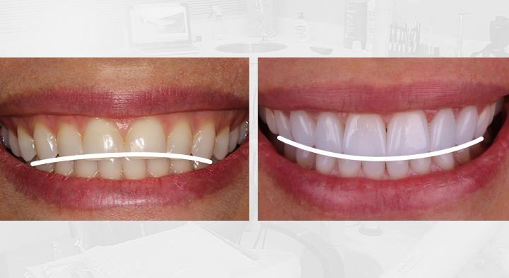 Sorriso Invertido, o que é e como corrigir - Rafael Mantovani